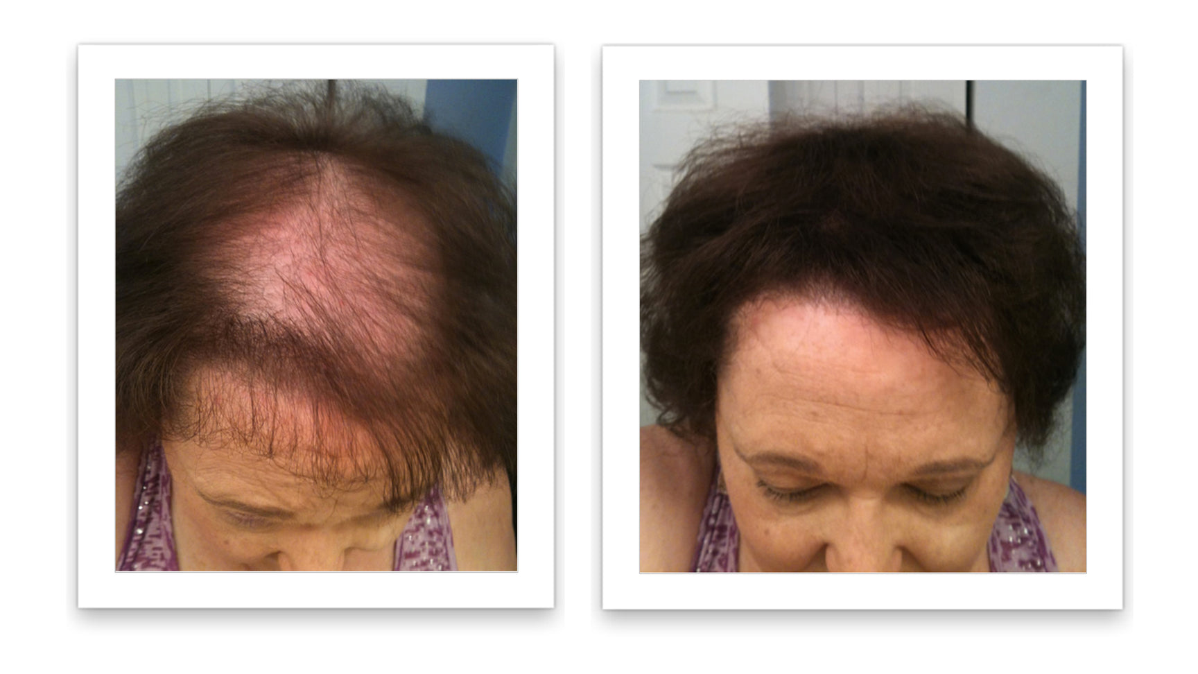 Caboki Hair Building Fiber, All-Natural Hair Loss Concealer, Best ...